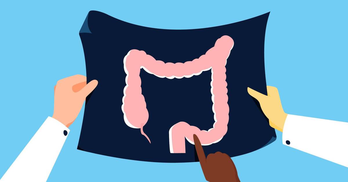 What Are Types of Colorectal Cancer Screening Tests? - Scripps Health