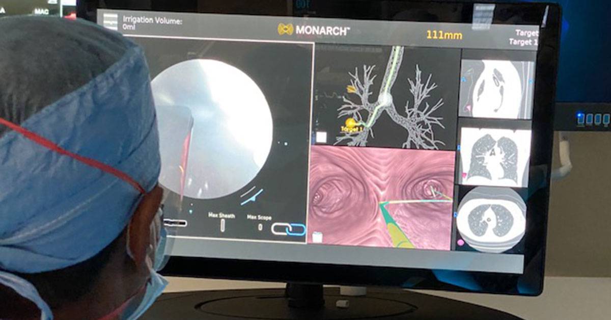 New Approach To Lung Cancer Diagnoses Makes Headlines Scripps Health