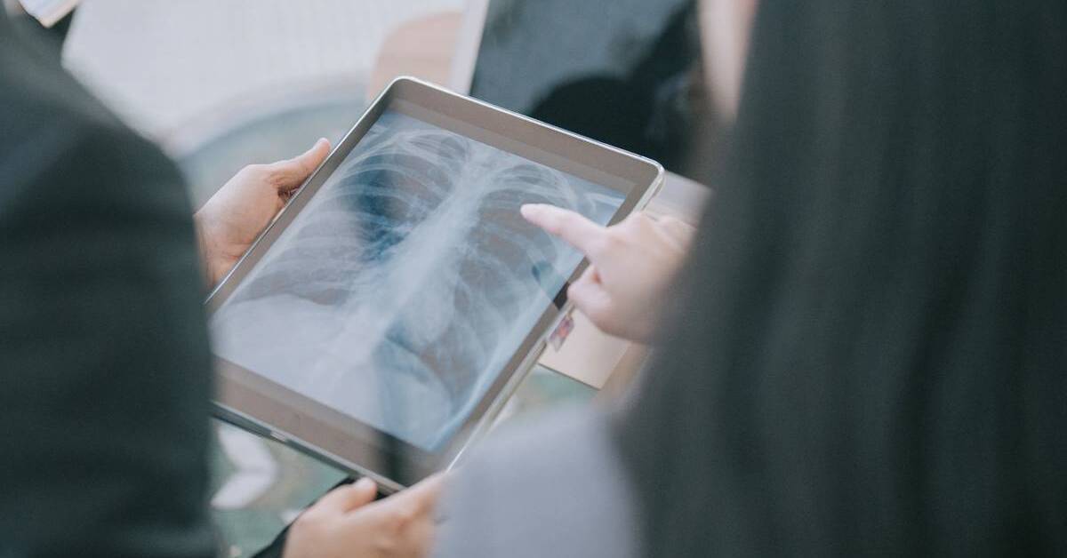 Lung Cancer Screening Saves Lives Scripps Health