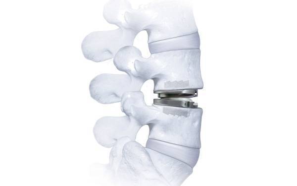 Trusted Care for Artificial Disc Replacement - Scripps Health